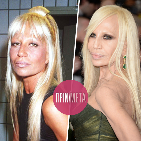 Before & After: Οι celebrities με τις πιο αποτυχημένες πλαστικές ...
